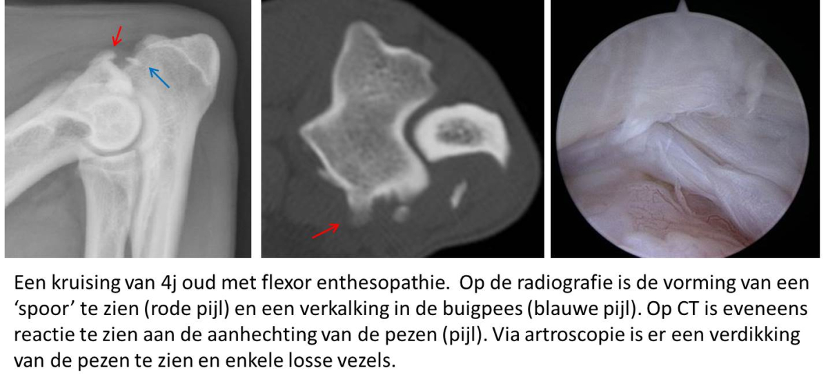 Flexor enthesopathie | Orsami: Medische beeldvorming Universiteit Gent